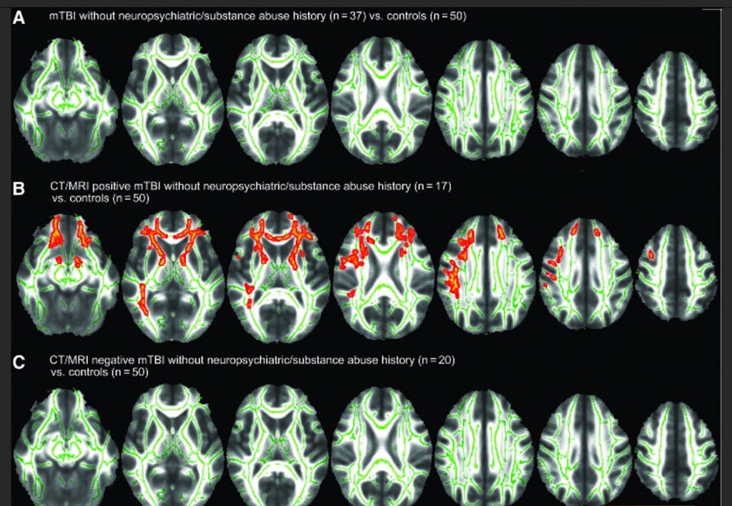 New Blood Test Helps Reveal Brain Injuries - UT Austin News - The ...