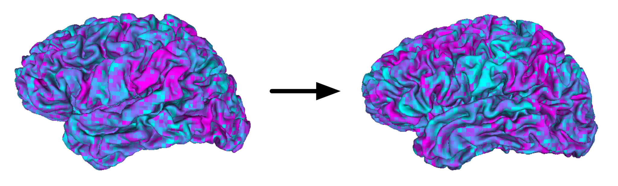 Improved Brain Decoder Holds Promise for Communication in People With ...